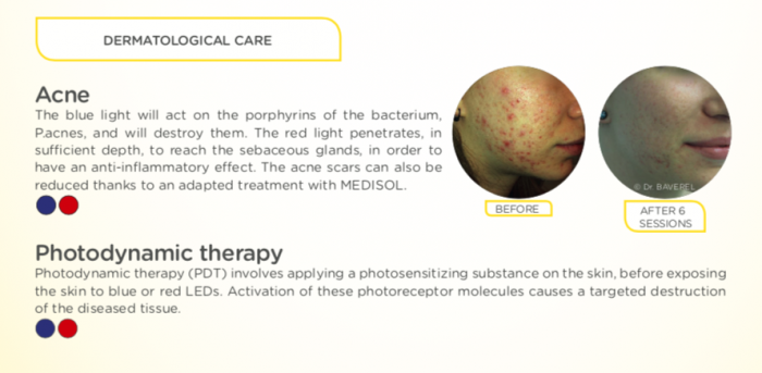 MEDISOL® - High Power LED using Photobiomodulation